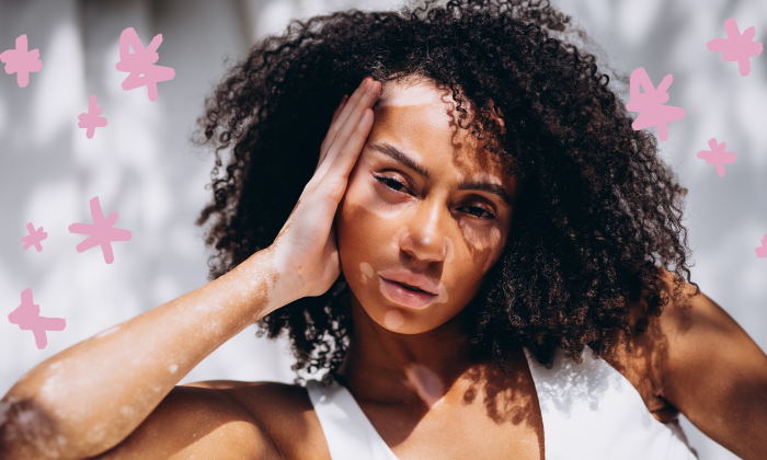 Mo-Yccia is model met vitiligo: 'Ik was bang dat mijn vlekken mensen ...